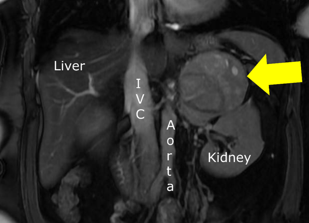 What is DHEA and What Does It Tell Me About My Adrenal Tumor?