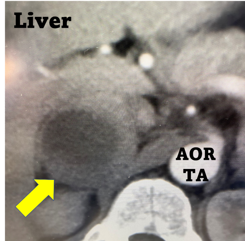 Choosing a Pheochromocytoma Specialist